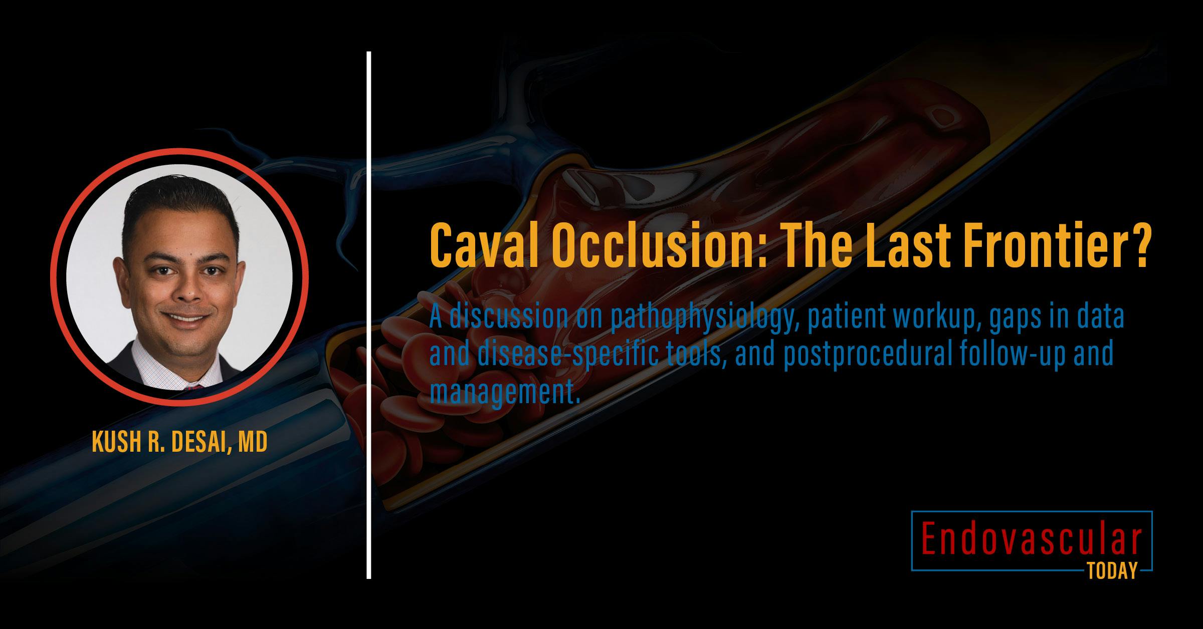 Caval Occlusion: The Last Frontier? - Endovascular Today